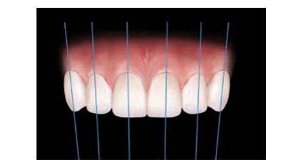 Cosmetic Dentistry in Orange County, Irvine - How to get a great smile