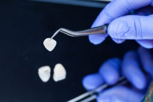 How Are Dental Veneers Removed? - Art of Dentistry Institute